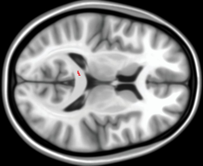 Ameis splenium MRI - Province of Ontario Neurodevelopmental Network
